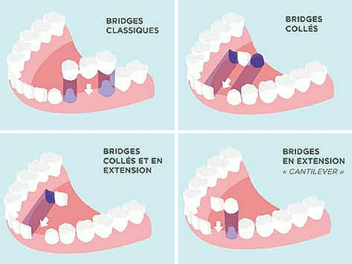 Dental bridge – Poissy dentiste
